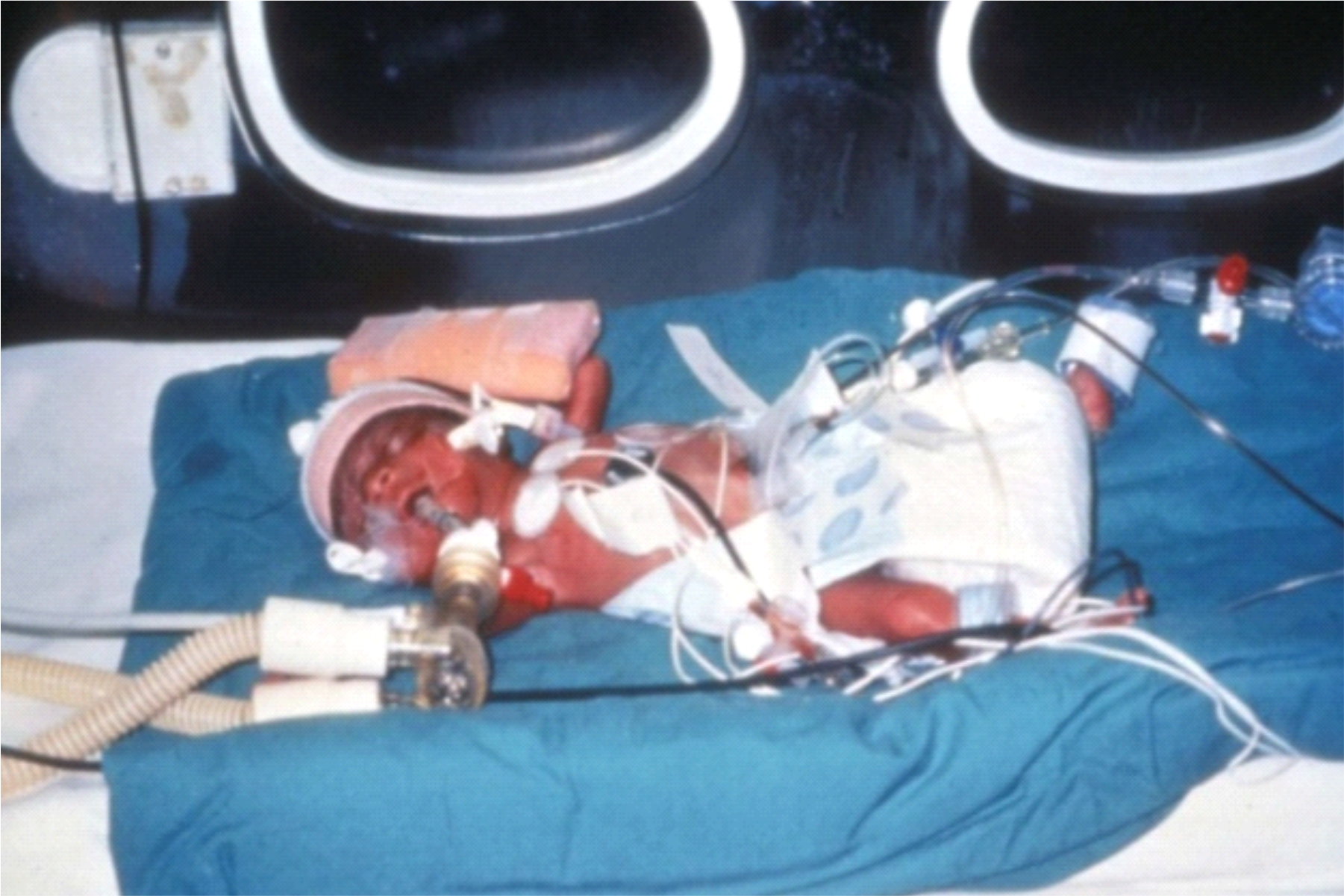 Retinopathy of Prematurity (ROP) Clinic - COAVS